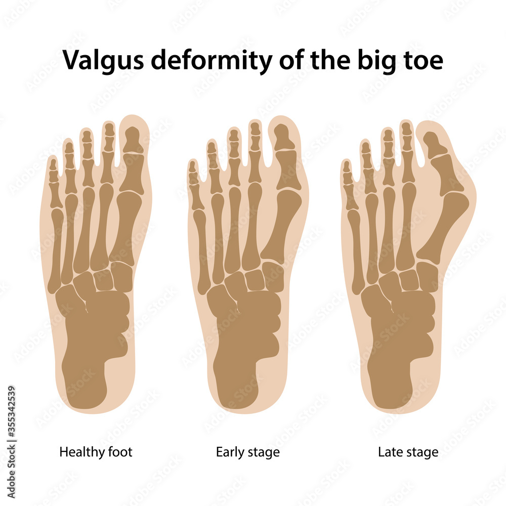 Valgus deformity of the big toe. Healthy foot and stages of development ...