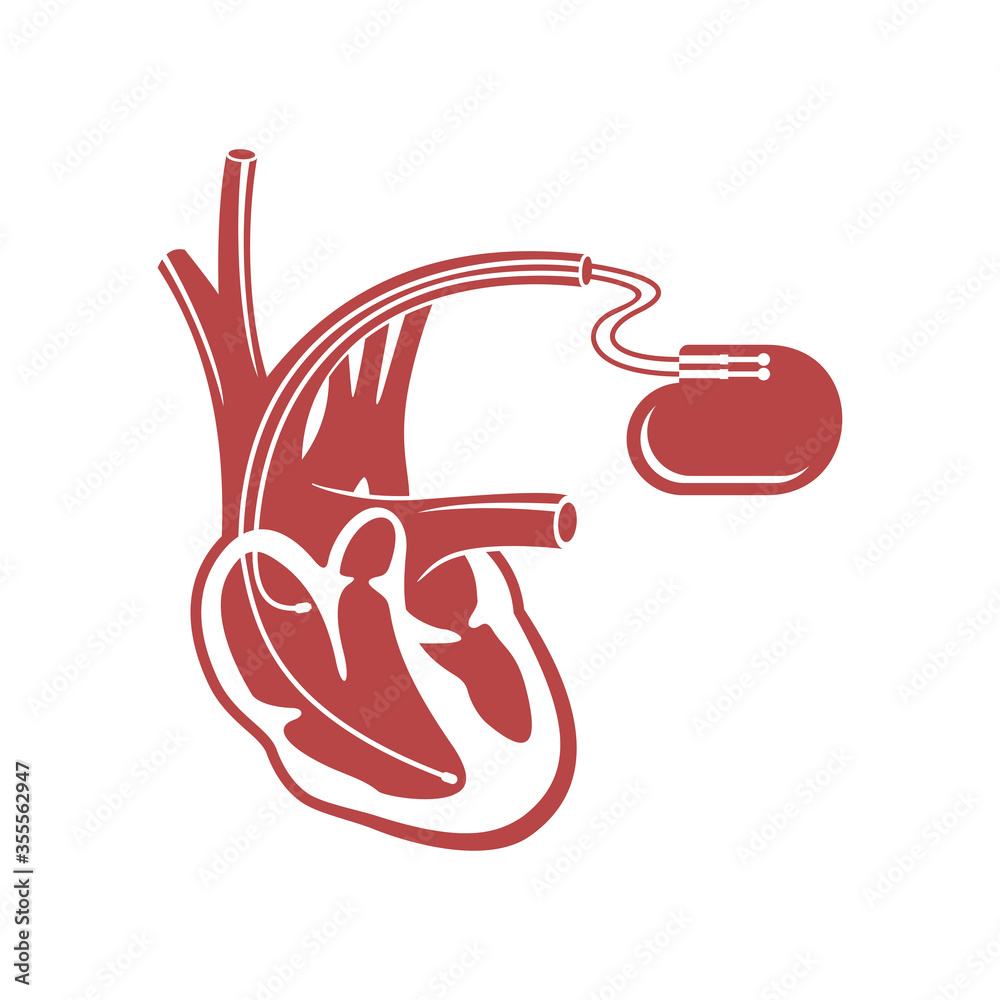 Pacemaker cardio stimulator flat icon (heart implant) - medical device ...