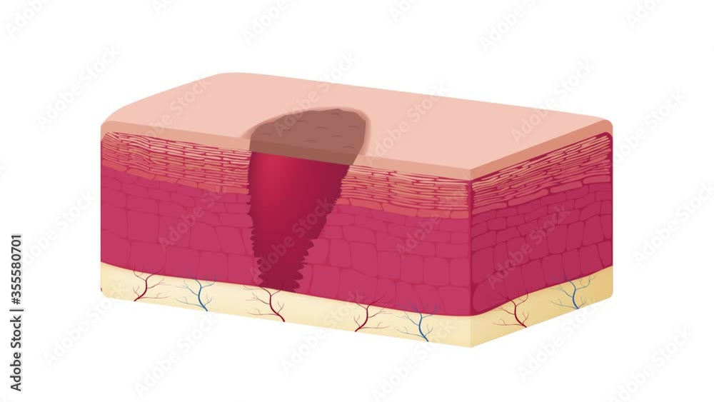 wound skin vector graphic . blood come out of wound graphic animation ...