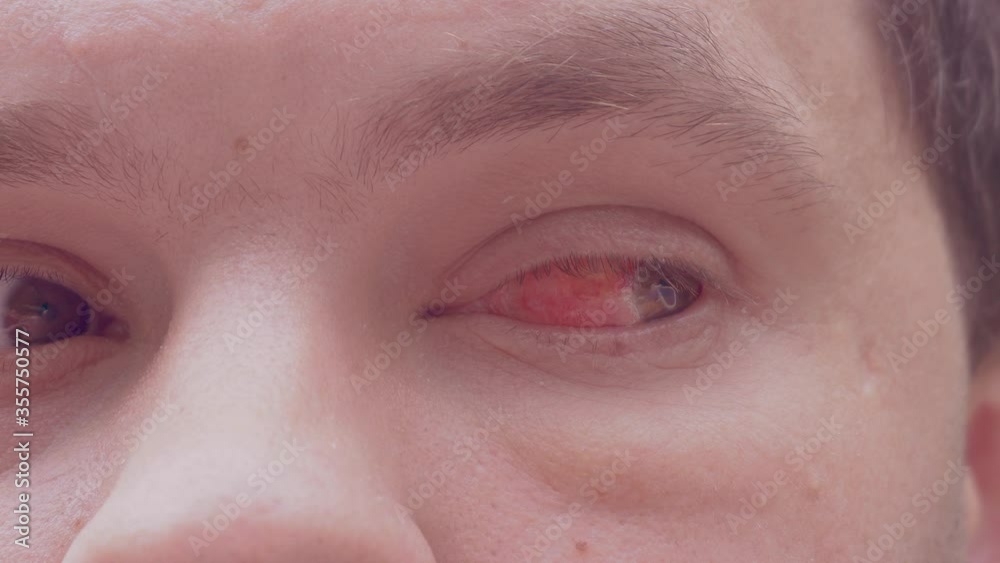 Close up. man eye with chemical burns of the cornea. burst capillaries ...