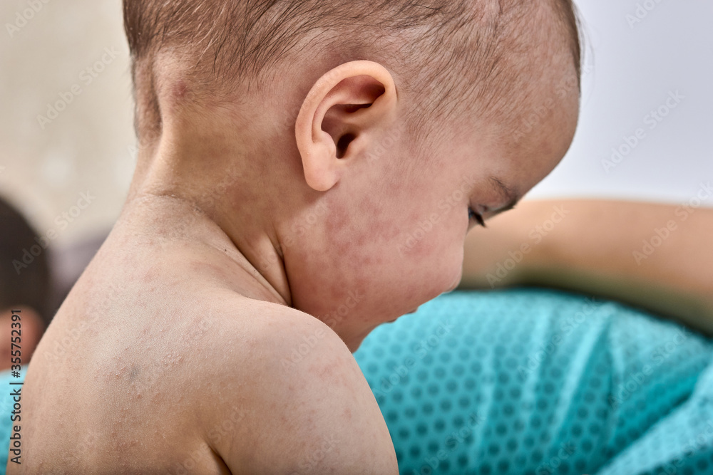 roseola rash a viral rash on the skin of a child Stock Photo | Adobe Stock