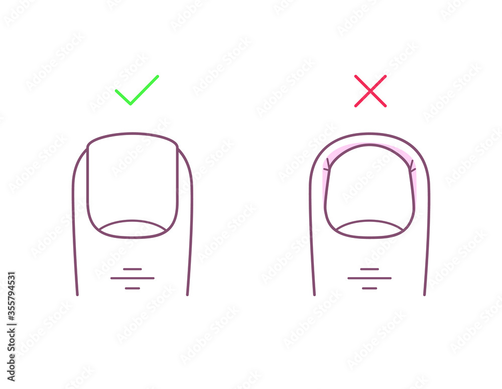 How to trim your toenails correctly. Proper and improper trimming of ...