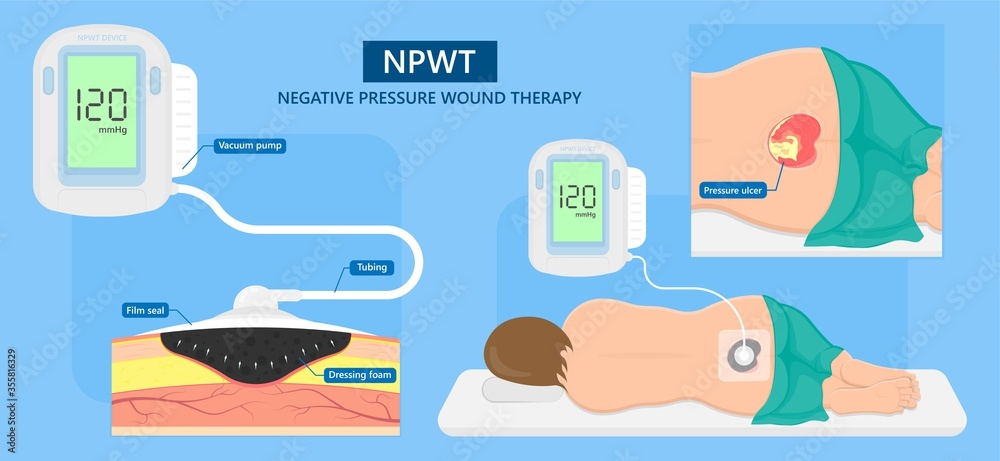 Vacuum assisted closure VAC drain tube treat dead damage pain medicine ...