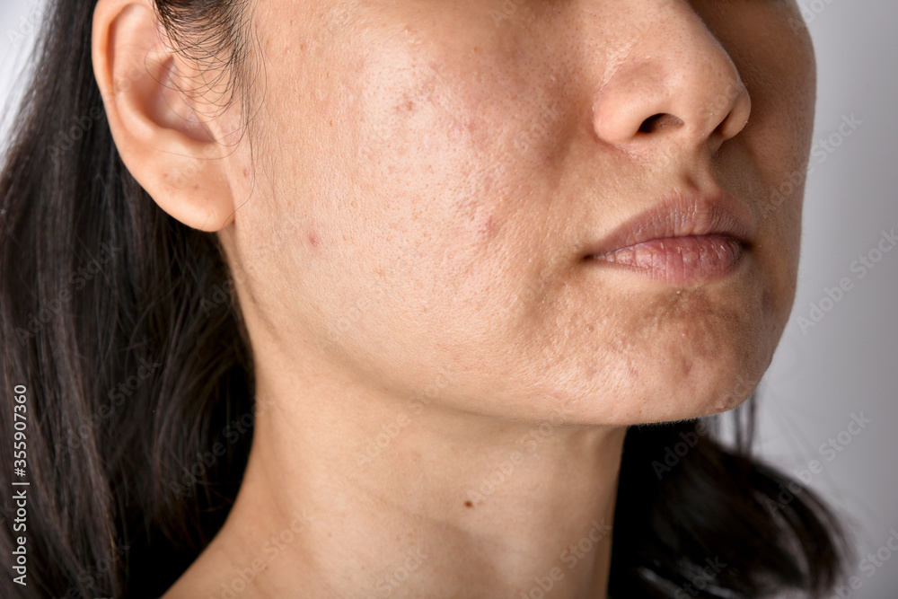 Skin problem with acne diseases, Close up of asian woman face with ...