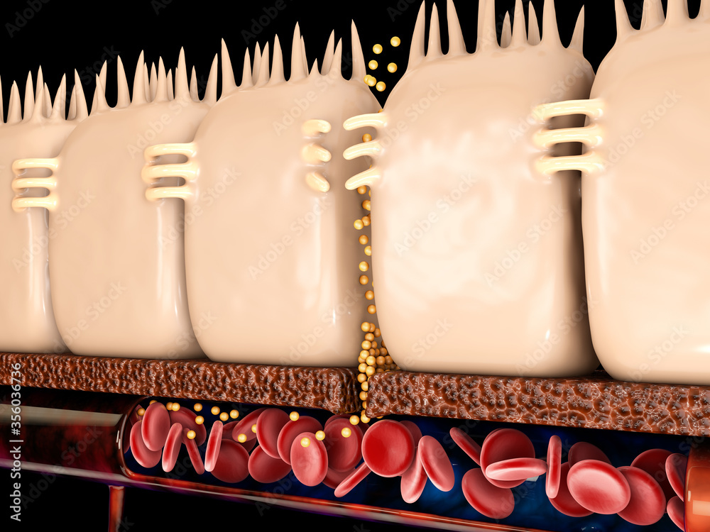 3d Rendering of leaky gut, in intestine with celiac disease and gluten ...