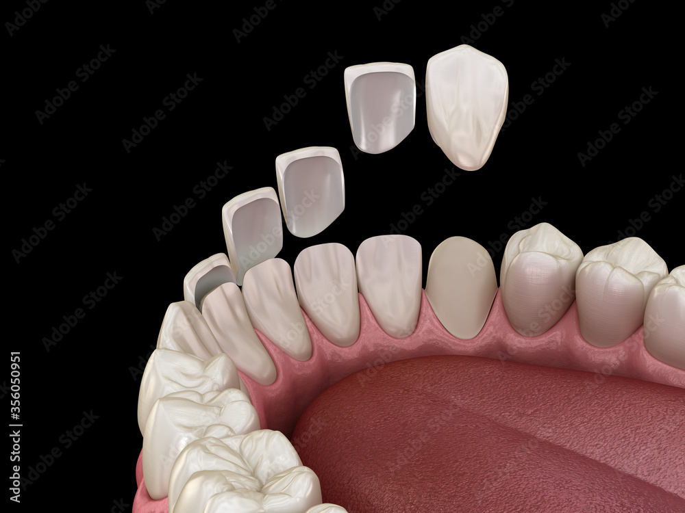 Veneer installation procedure over central incisor and lateral incisors ...