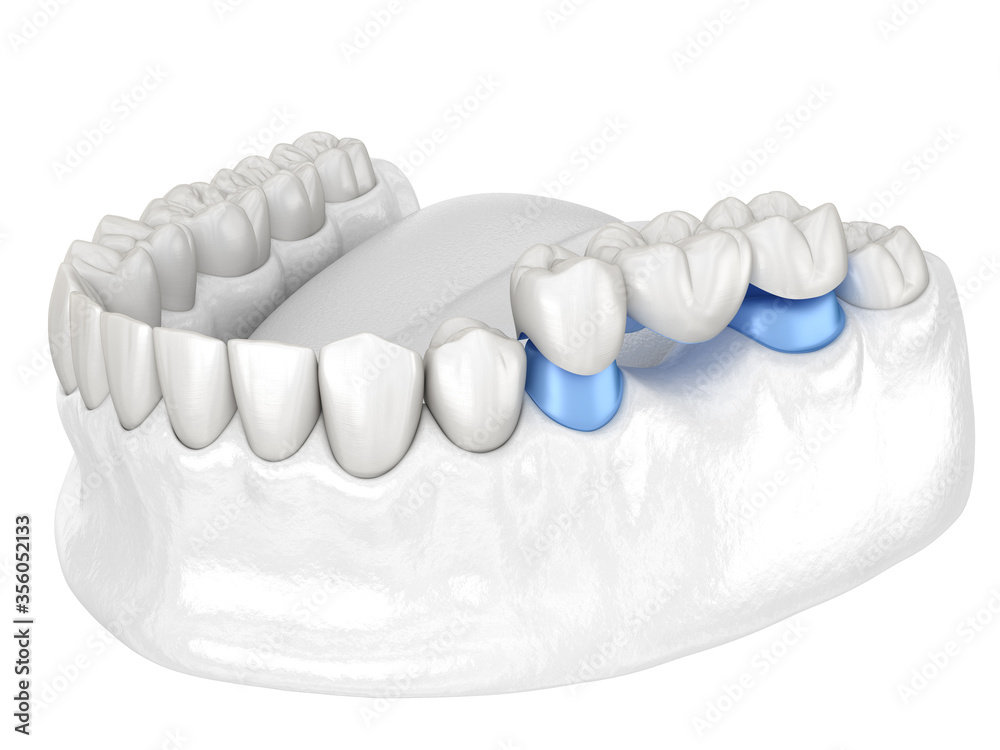 Porcelain Dental bridge of 3 teeth over molar and premolar. Medically ...
