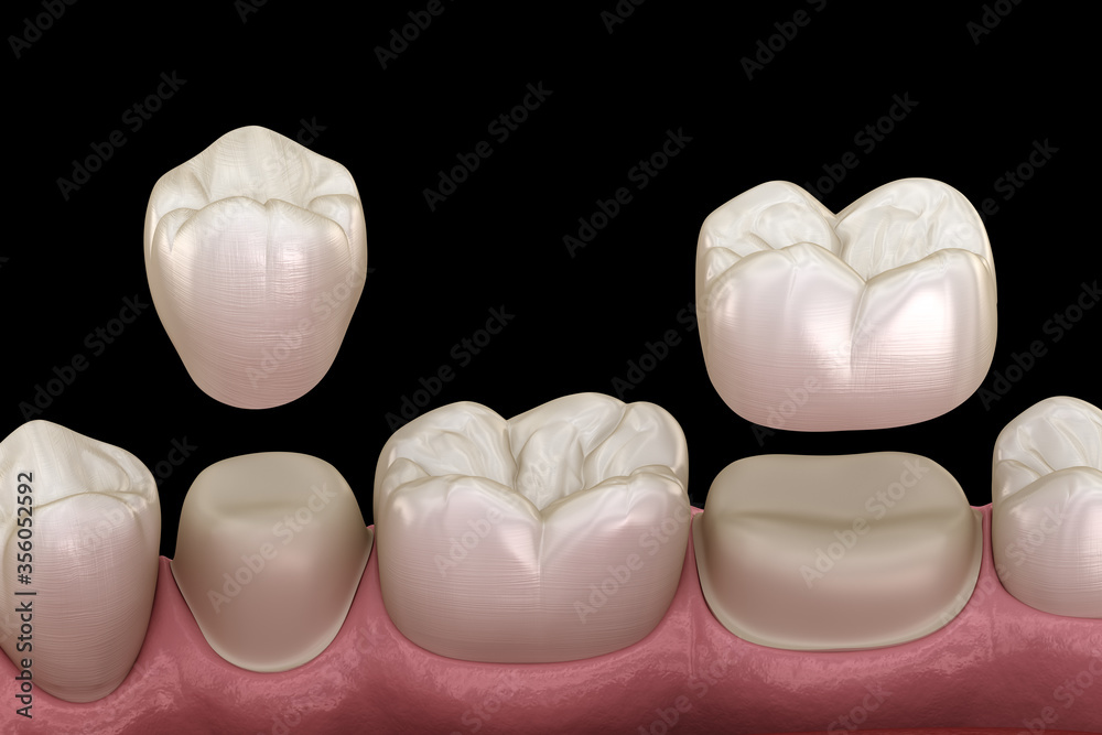 ภาพประกอบสต็อก Porcelain crowns placement over premolar and molar teeth ...
