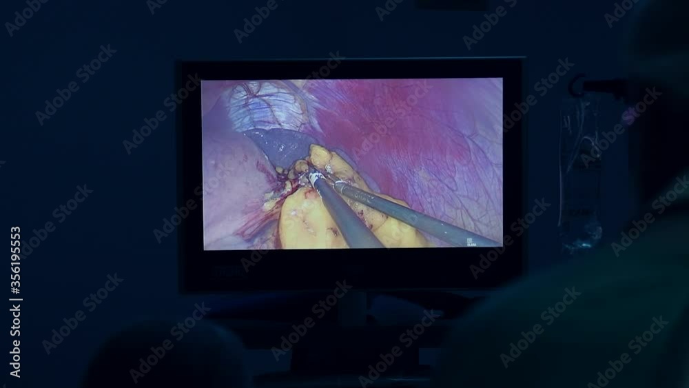 Surgeon performing laparoscopic surgery. Laparoscopic surgery on the ...
