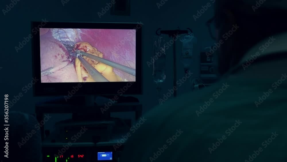 Surgeon performing laparoscopic surgery. Laparoscopic surgery on the ...