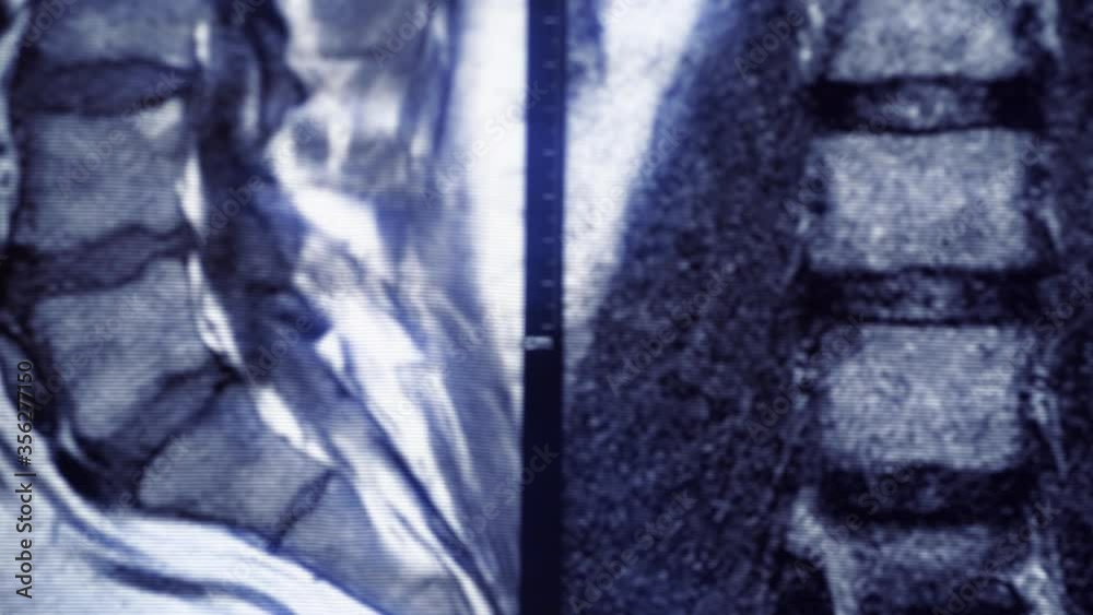 Macro panorama of MRI of lumbar spine with osteochondrosis, age-related ...