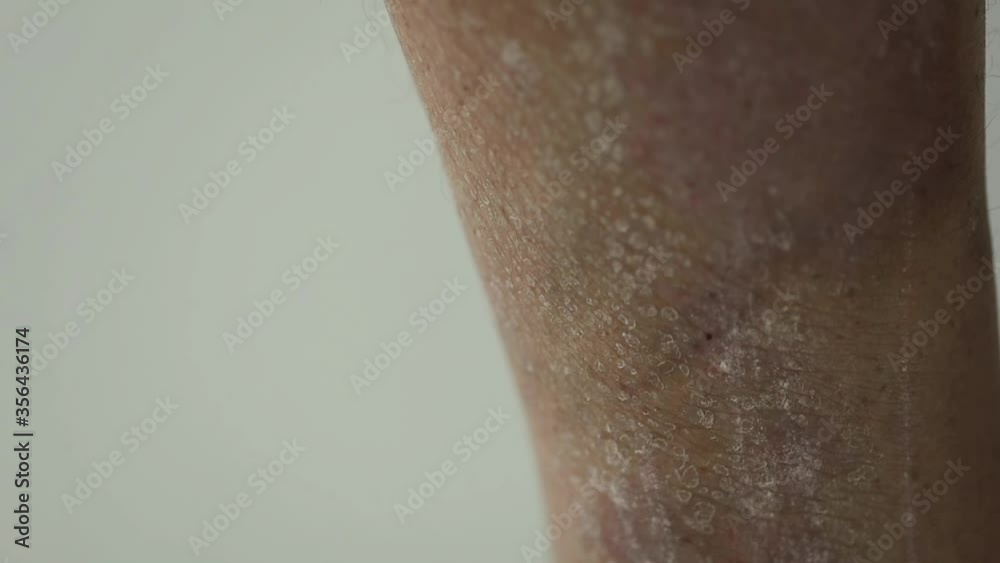Psoriasis. The area of the lower leg affected by psoriatic plaques ...
