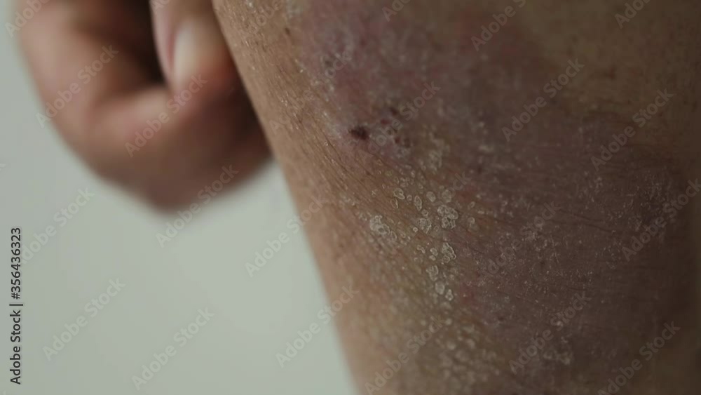 Psoriasis. A man combs the area of the lower leg affected by psoriatic ...