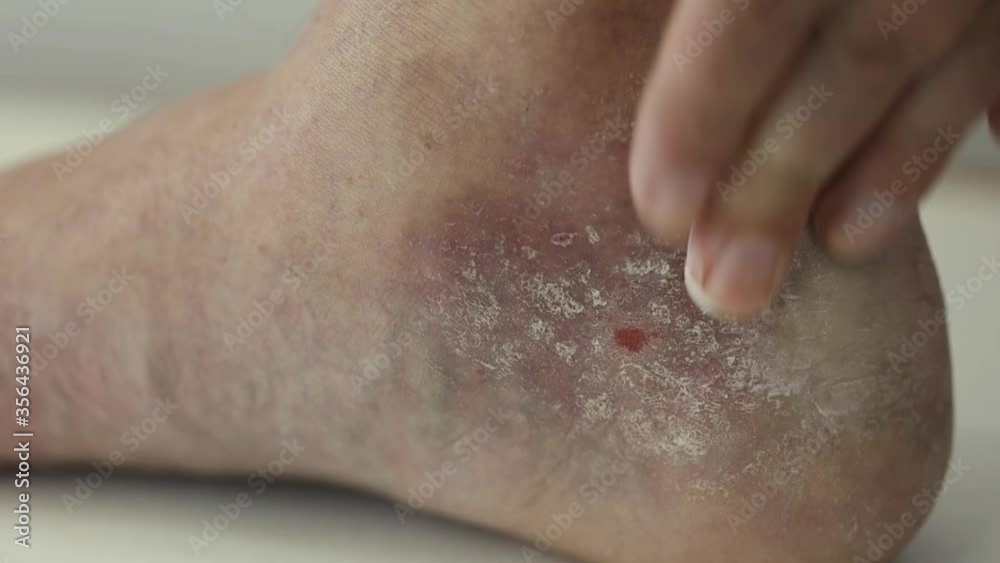 Psoriasis. The man rubs the ointment into the affected part of the foot ...