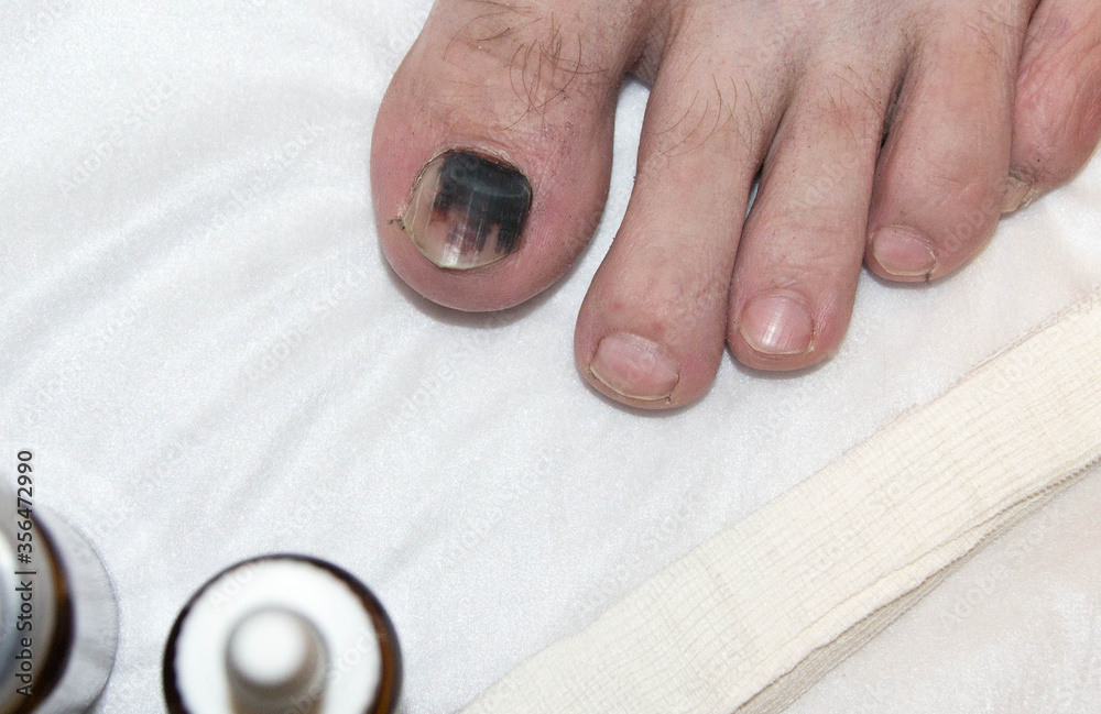 injury of a blackened chipped toenail in a man treatment and prevention ...