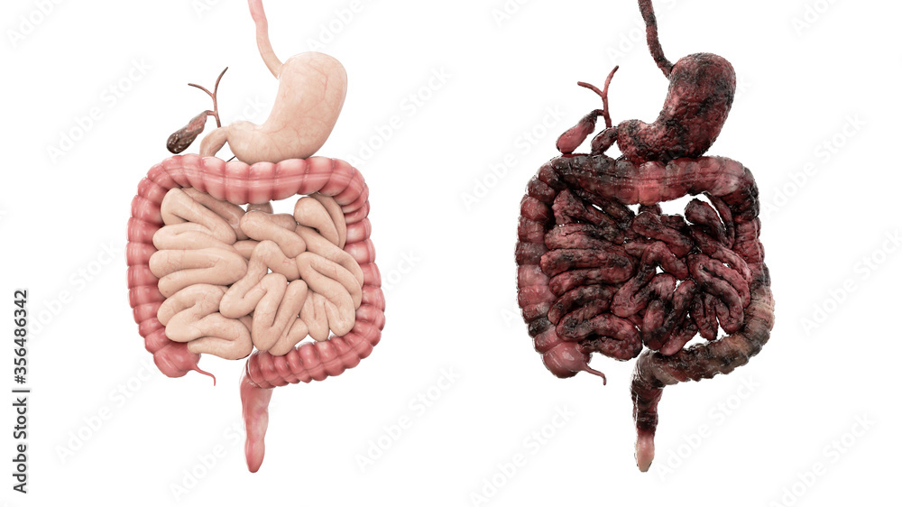 healthy intestines and disease intestines on white isolate. Autopsy ...