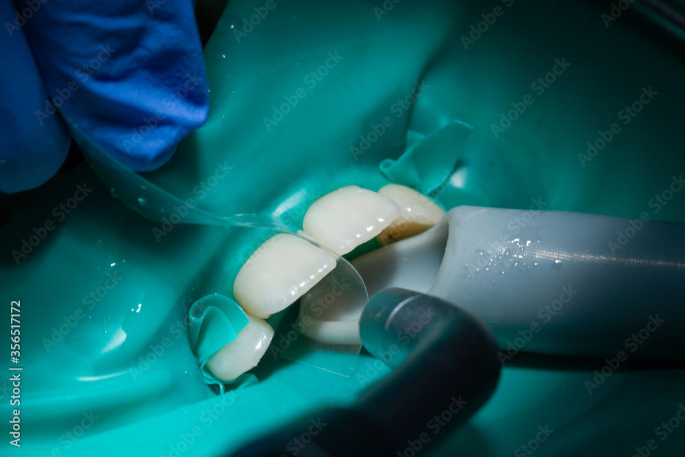 Inspection and treatment of anterior teeth at the dentist, cofferdam is ...