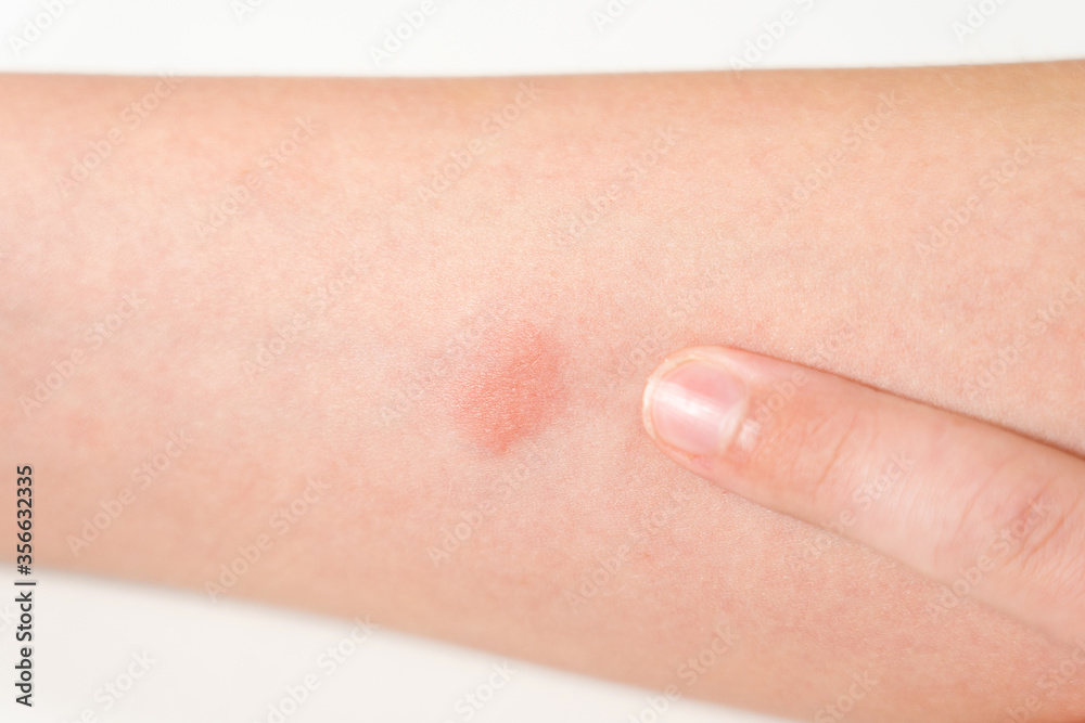Cara Melihat Hasil Tes Mantoux Koreksi Id - vrogue.co Cara Melihat Hasil Tes Mantoux Koreksi Id - vrogue.co