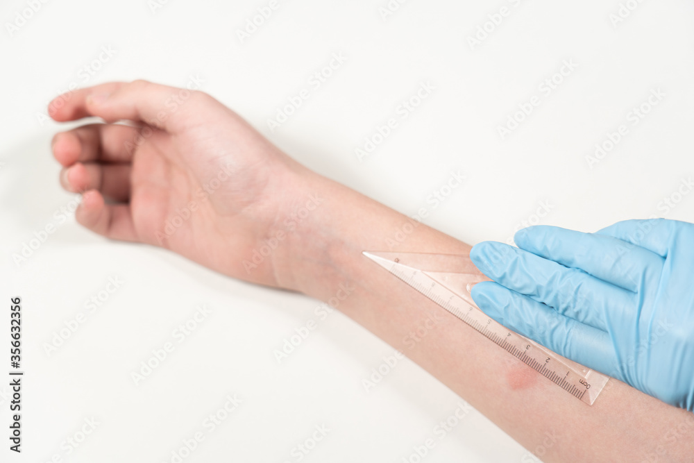 Foto de Closeup view photography of child arm with red spot reaction to ...