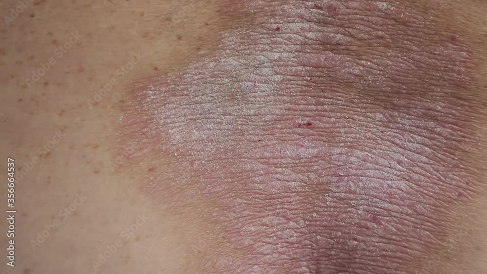 psoriasis: the area of the skin of the back of a person affected by ...