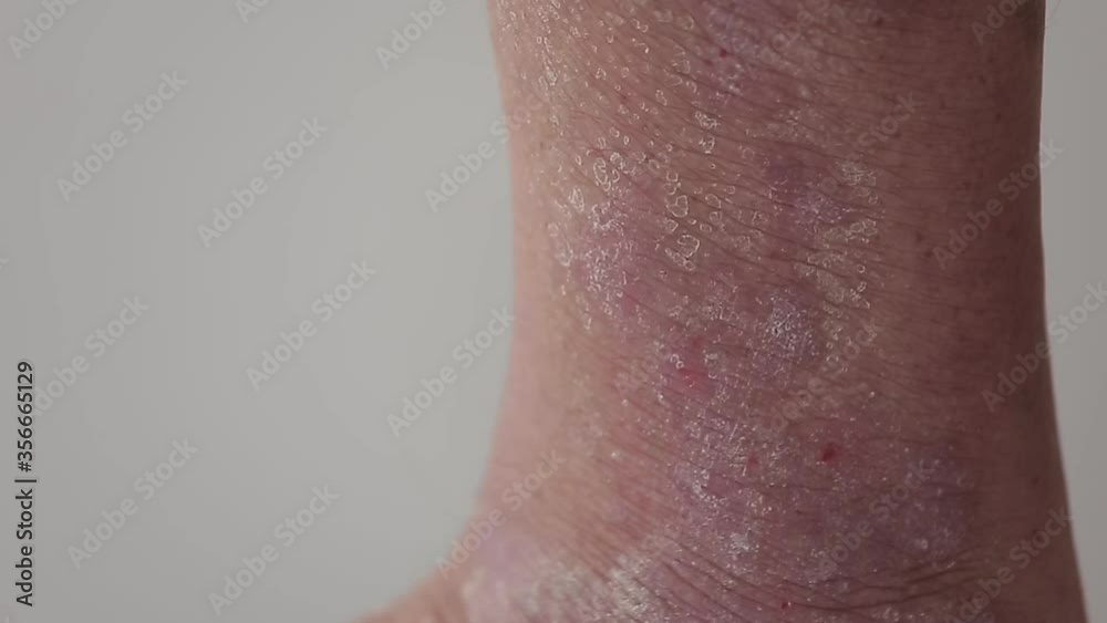 Psoriasis. A man combs the area of the lower leg affected by psoriatic ...
