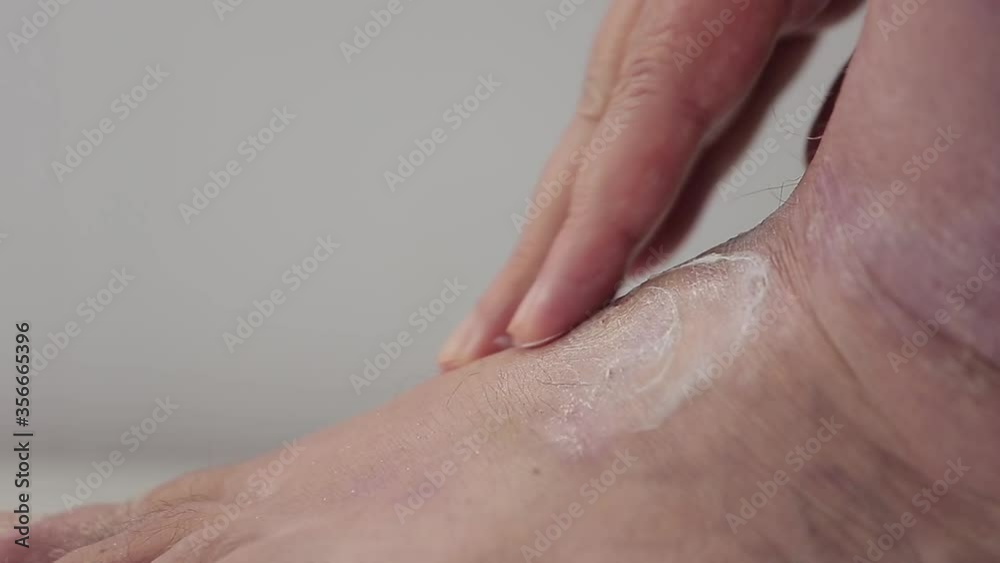 Psoriasis. The man rubs the ointment into the affected part of the foot ...