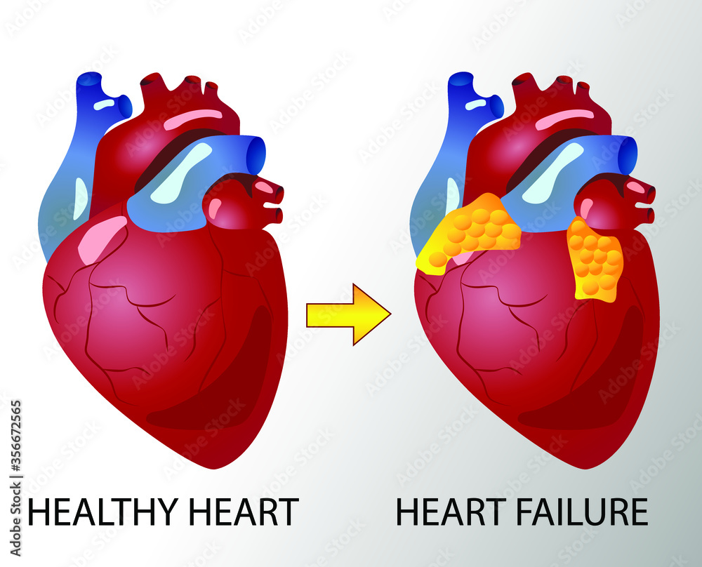 Diagram showing human hearts illustration. Heart attack and ...