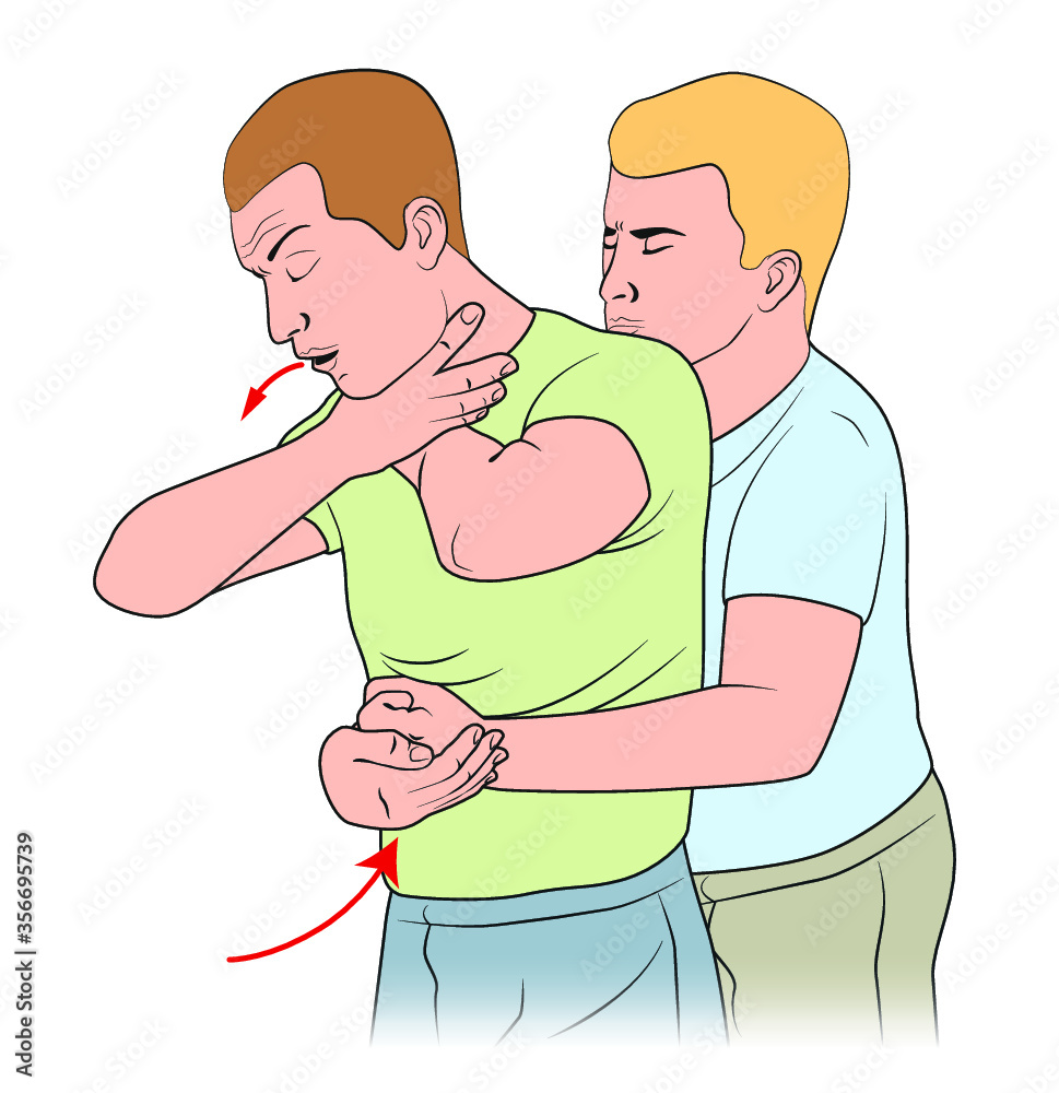 Stockvector Maniobra de Heimlich en adultos - Primeros auxilios | Adobe ...