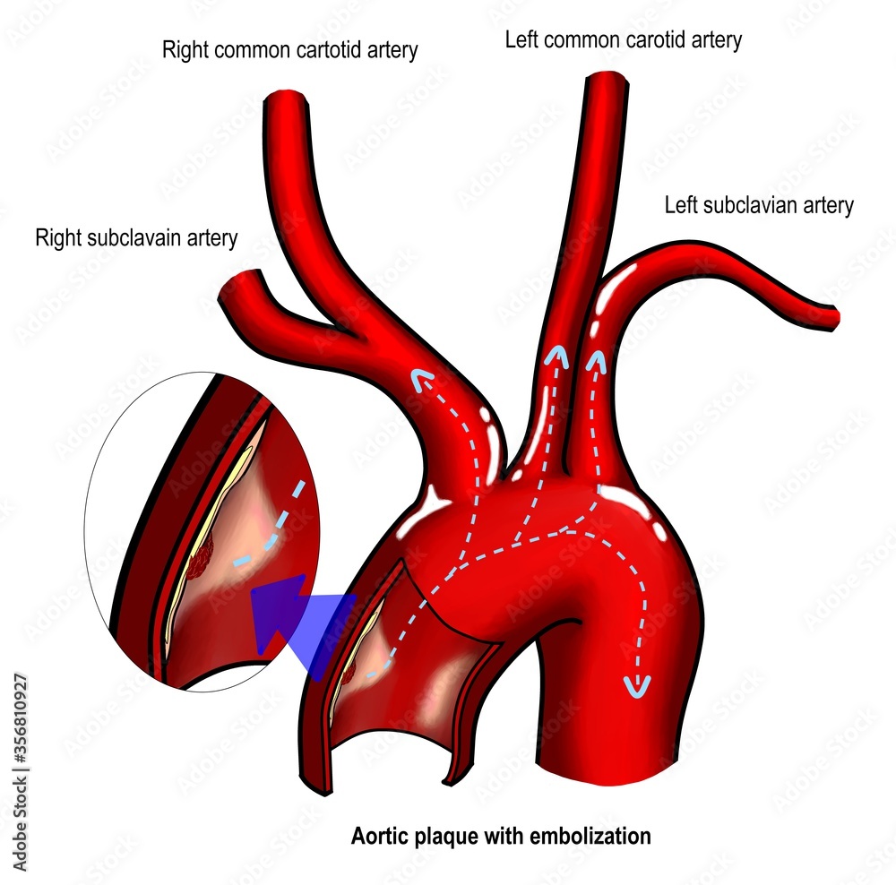 Aortic atherosclerosis and arotic plaque embolization are one of the ...