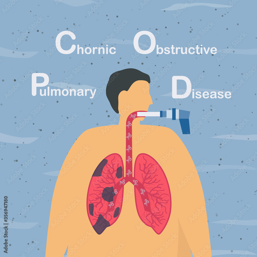 Spirometry is a test used to measure lung function. Chronic obstructive ...