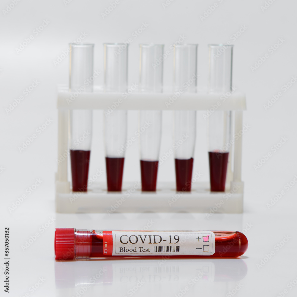 COVID-19 positive result test and laboratory sample of blood testing ...