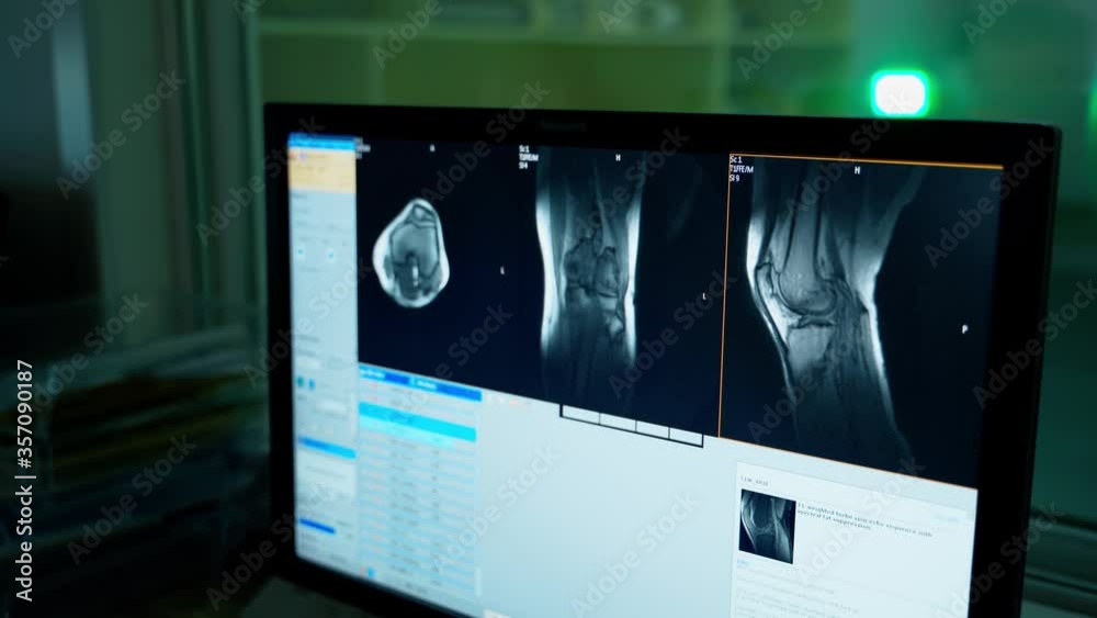 X-ray shots on the monitor. Pictures of patient's bones on the computer ...