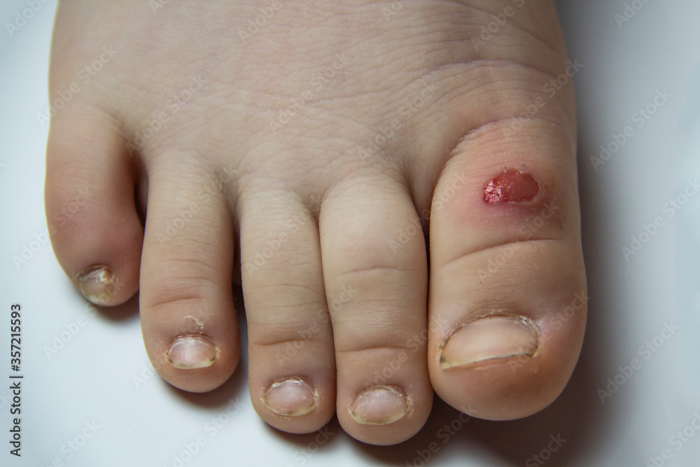 Callus on the leg of a young boy. children foot with problem areas on ...