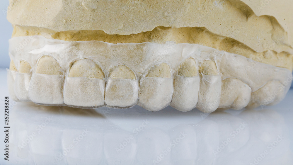 dental cap for plastic surgery to cut the gums of the upper jaw of the ...
