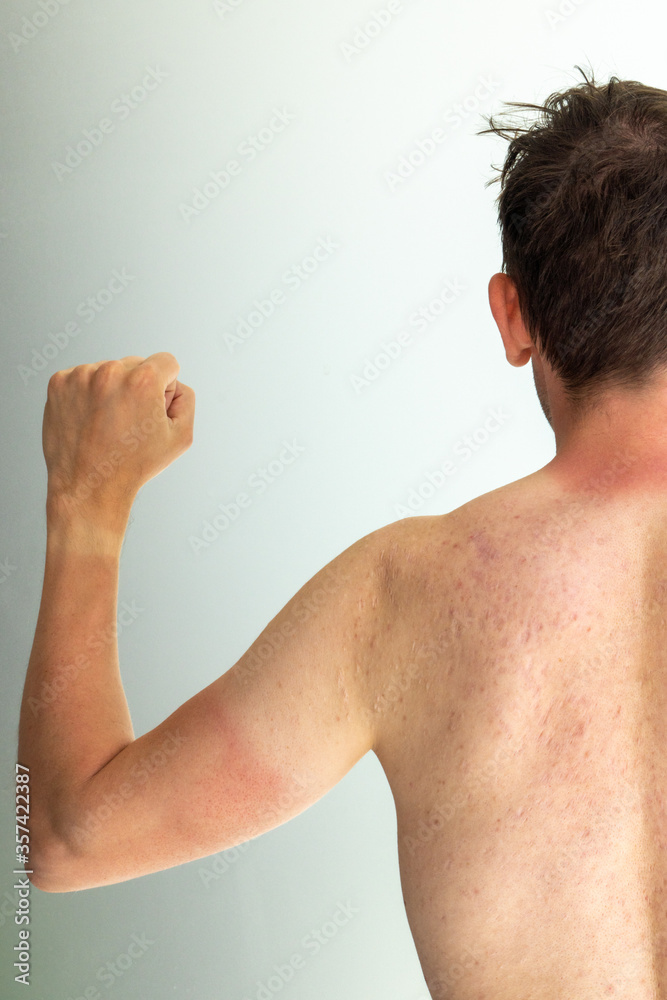 The guy burned in sun in city, the silhouette of t-shirt and watch ...