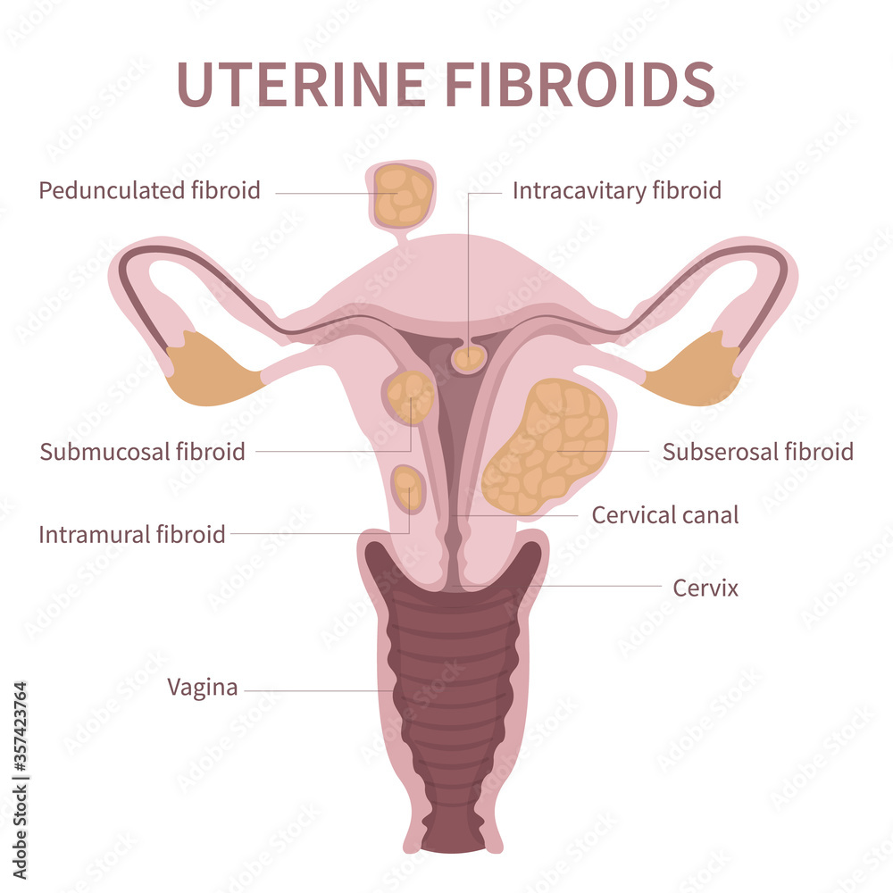 Reproductive System Picture Displays Pedunculated Intracavitary