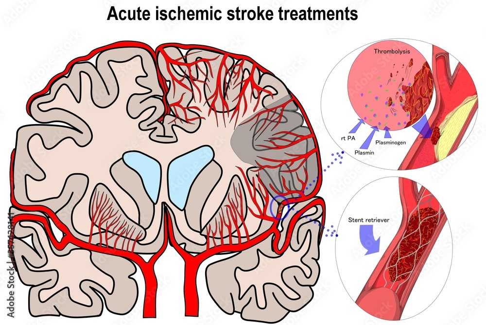 Acute Ischemic Stroke