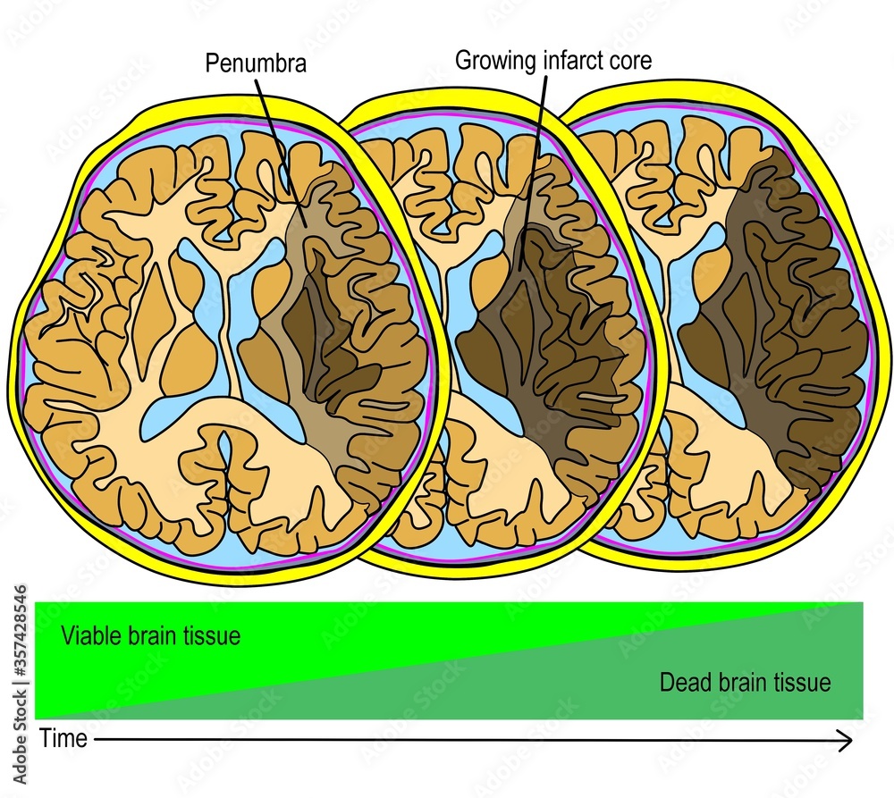 The timeline and the progression of ischemic stroke. Stock Illustration ...