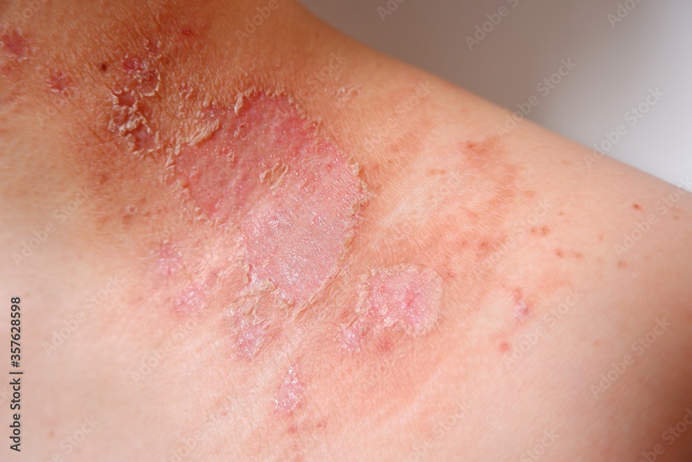 Bad skin condition because of poison liquid of dangerous insect, name ...