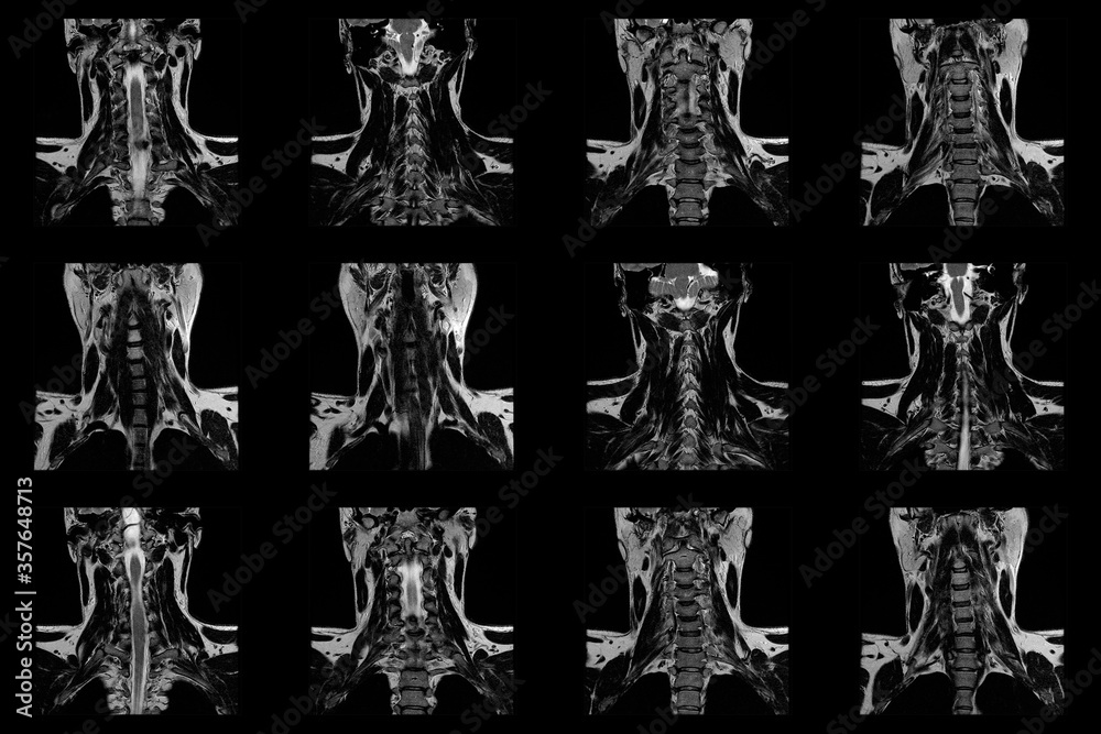 Poster set of coronal MRI scans of neck area of caucasian male with ...