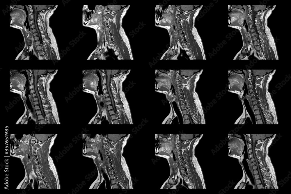 set of sagittal MRI scans of neck area of caucasian male with bilateral ...