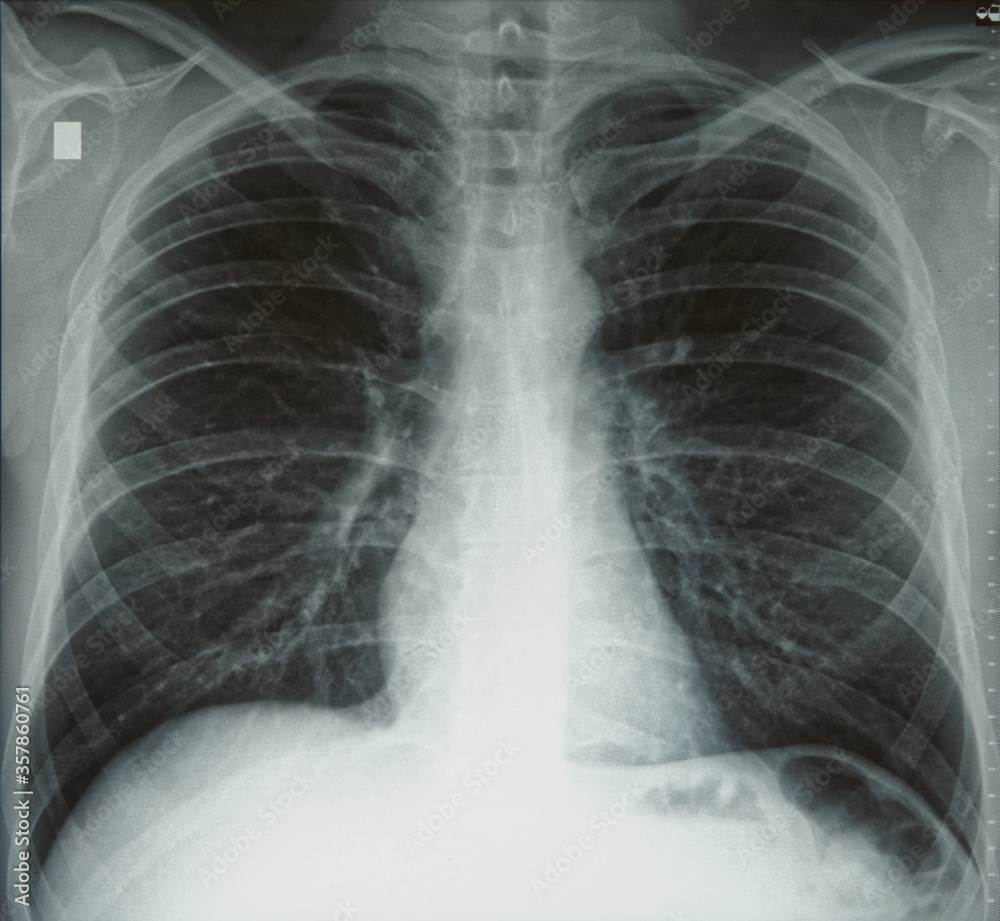 Plain chest x-ray, normal healthy lungs Stock Photo | Adobe Stock