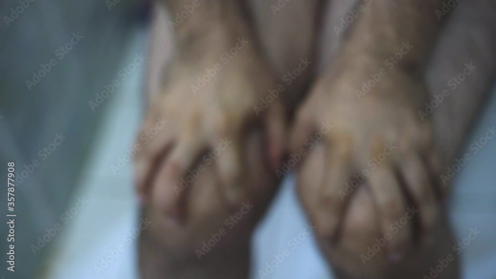 Man with hemorrhoids sitting in the toilet bowl. In the bathroom, VC ...