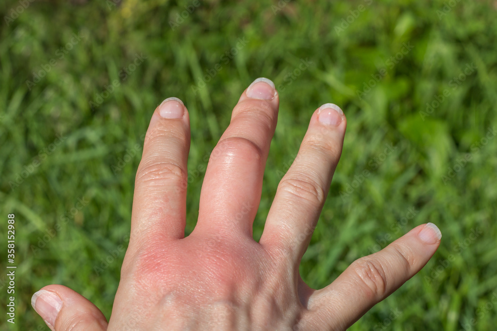 fragment of right hand with a swollen large middle finger after a bee ...