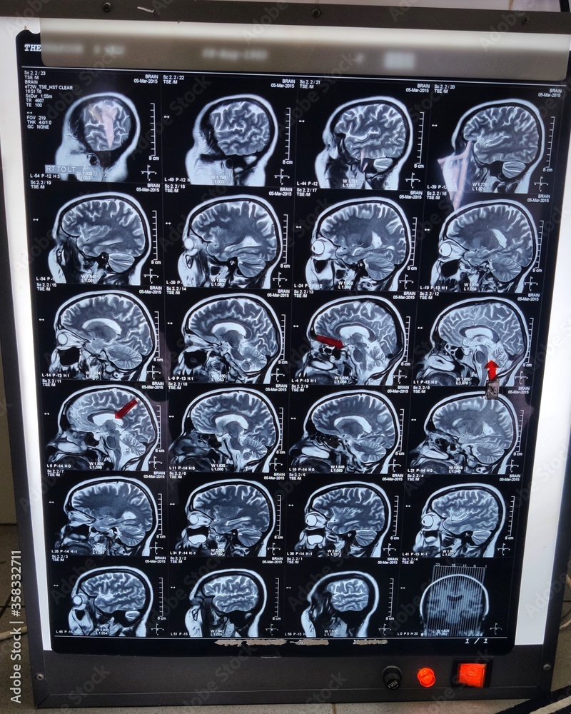 CT scan of sagittal section of head Stock Photo | Adobe Stock