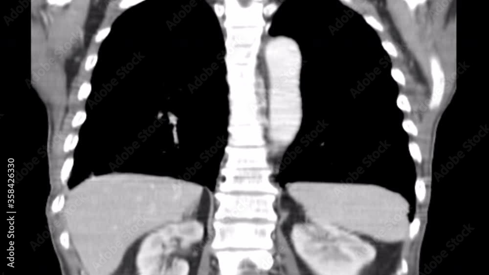 CT chest lung coronal view with contrast Male 77year old abscess lung ...