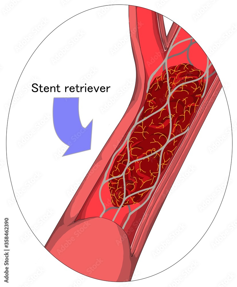 mechanincal thrombectomy is the treatment of acute ischemic stroke ...