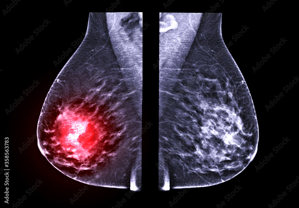 Stockfoto X-ray Digital Mammogram both breast MLO view , mammography or ...