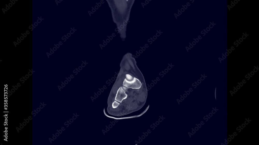 CT Foot foot coronal view for diagnosis fracture of the foot. vídeo de ...