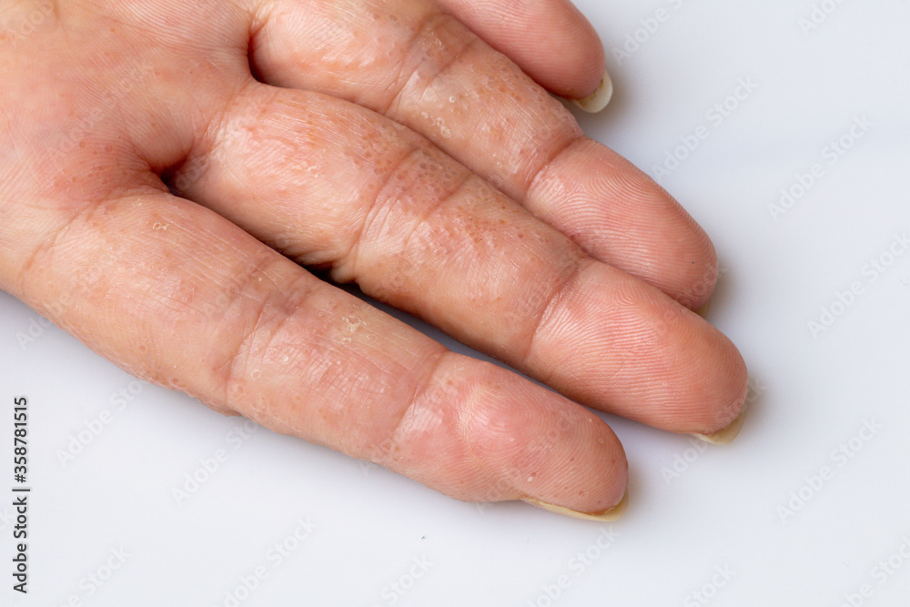 Close up Atopic dermatitis on finger(AD), also known as Atopic eczema ...